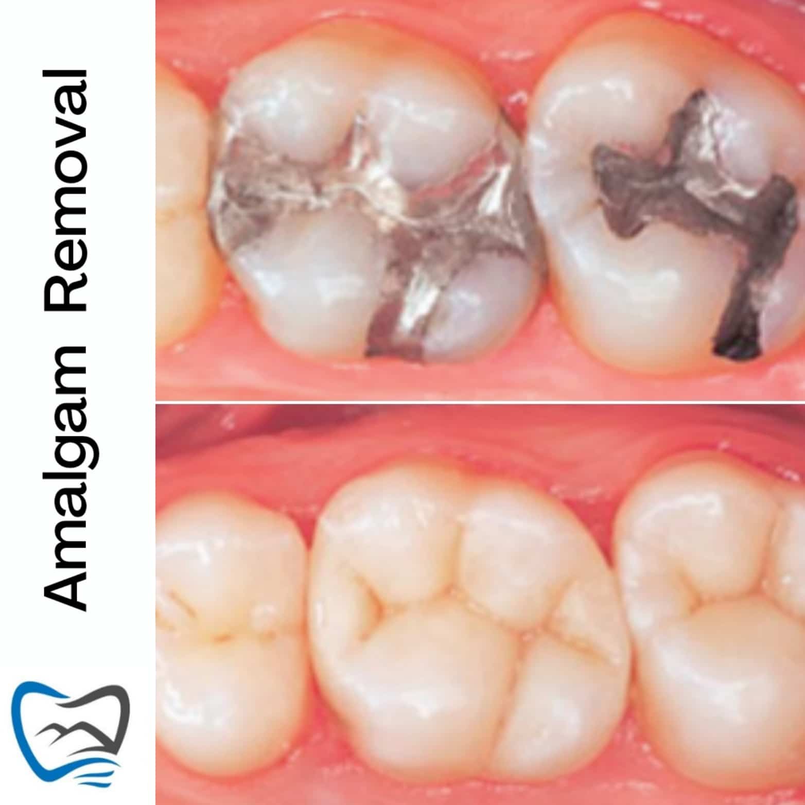 Tooth Fillings - Canyon View Dentistry